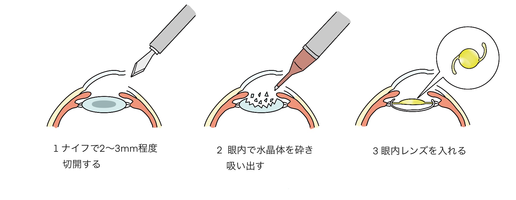 白内障 - HOYA株式会社