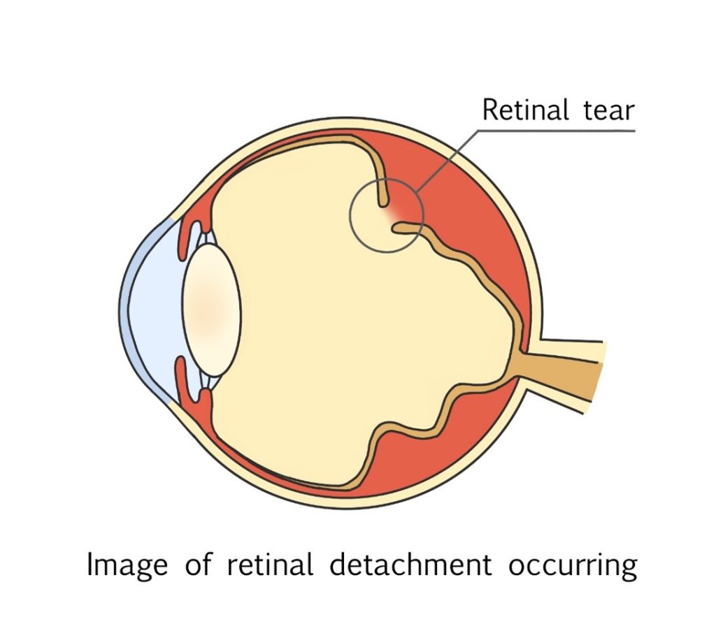 Retinal Detachment - HOYA Corporation