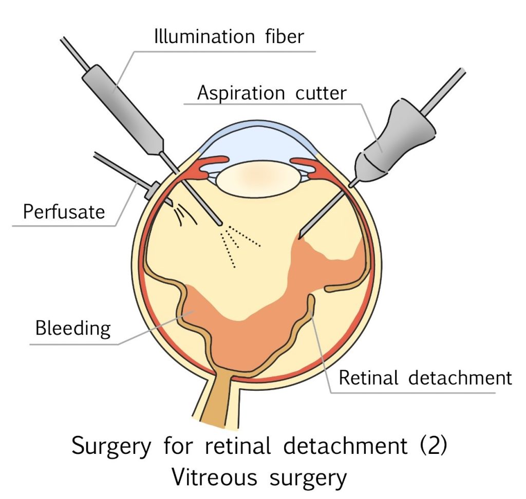 Retinal Detachment - HOYA Corporation