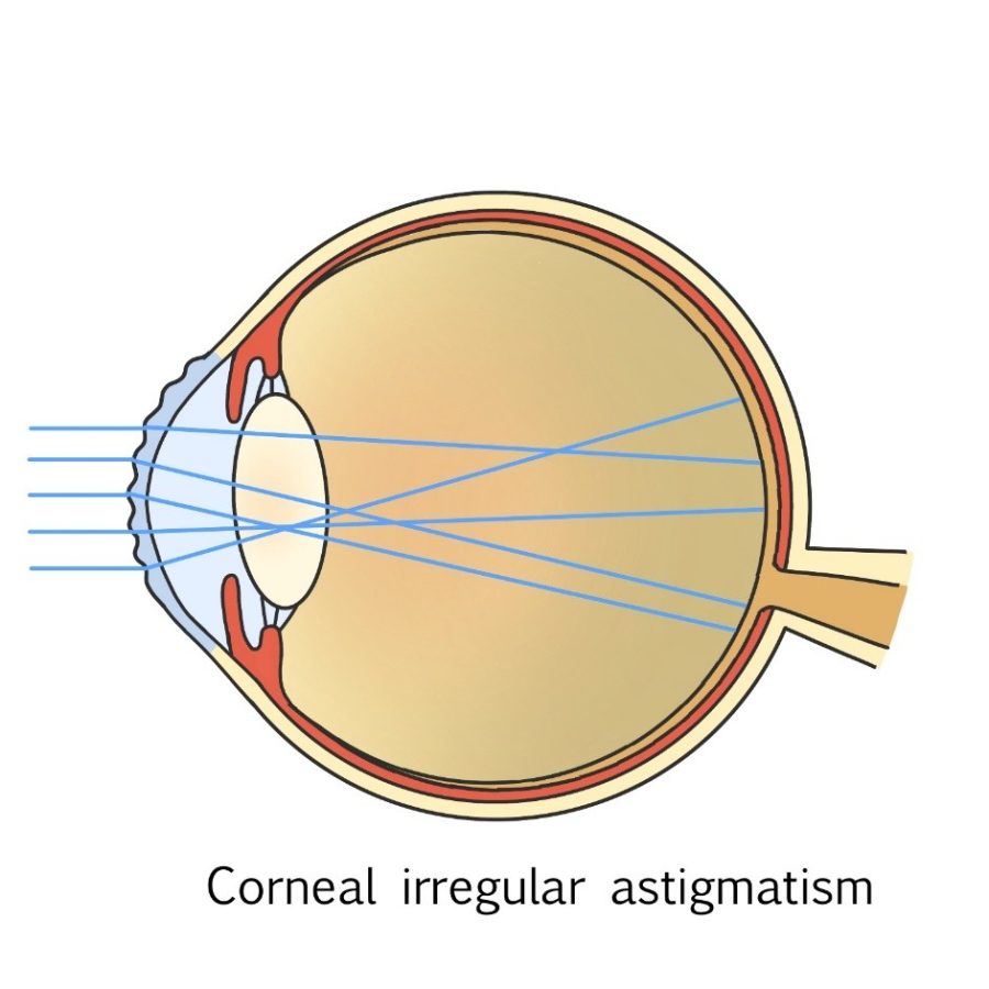 Astigmatism - HOYA Corporation