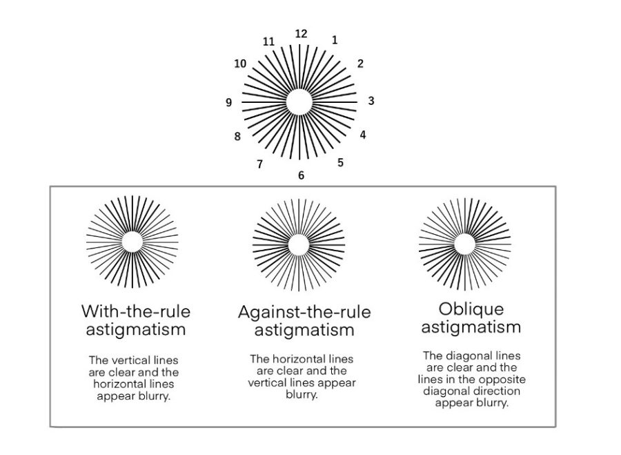 Astigmatism - HOYA Corporation