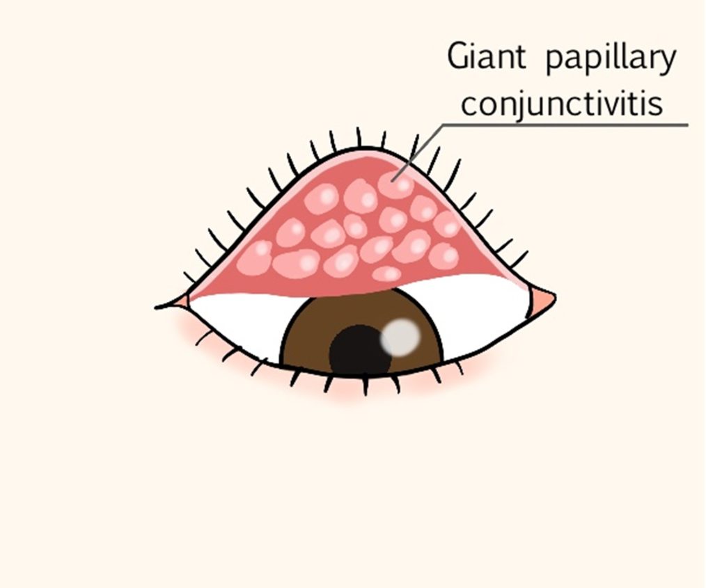 Allergic Conjunctivitis - HOYA Corporation