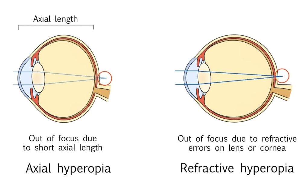 Hyperopia - HOYA Corporation