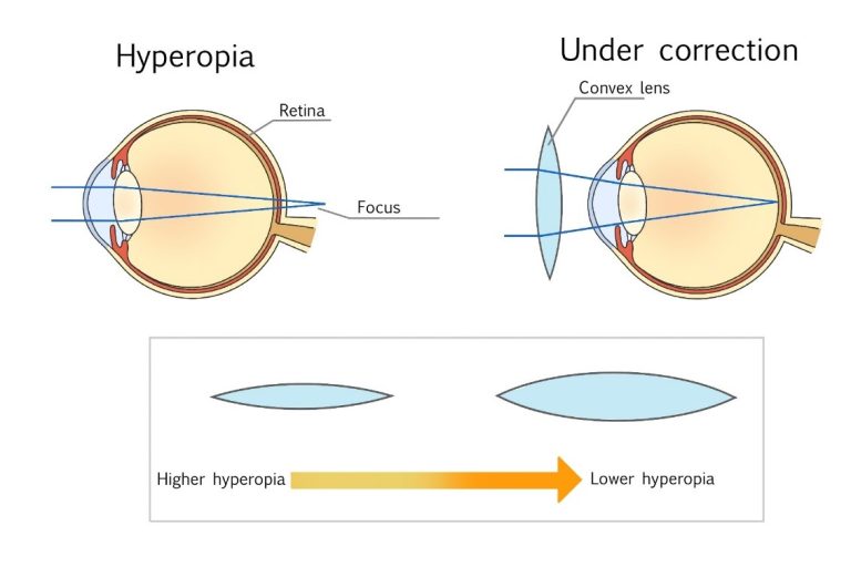 Hyperopia - HOYA Corporation