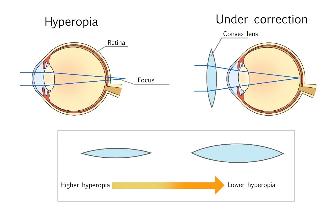 Hyperopia - HOYA Corporation