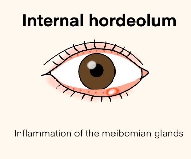 Hordeolum(Stye) - HOYA Corporation