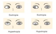 Strabismus - HOYA Corporation